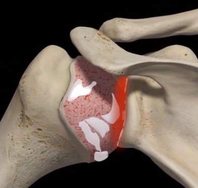 One common form of shoulder arthritis is an autoimmune condition called ...